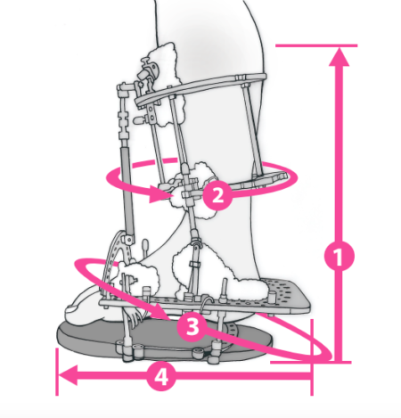 External Fixators, Ex-Fixes, and Halo's: Custom Covers to Help You Heal!