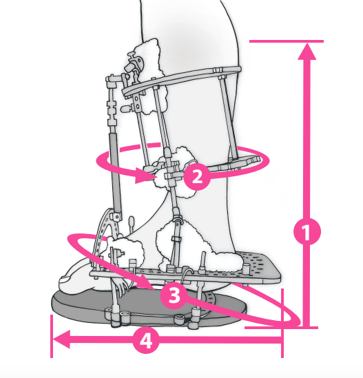 External Fixators, Ex-Fixes, and Halo's: Custom Covers to Help You Heal!